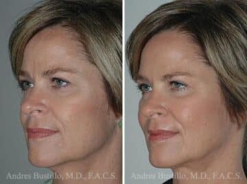 Neck Lift Miami - Rejuvenate Your Neck with Dr. Bustillo