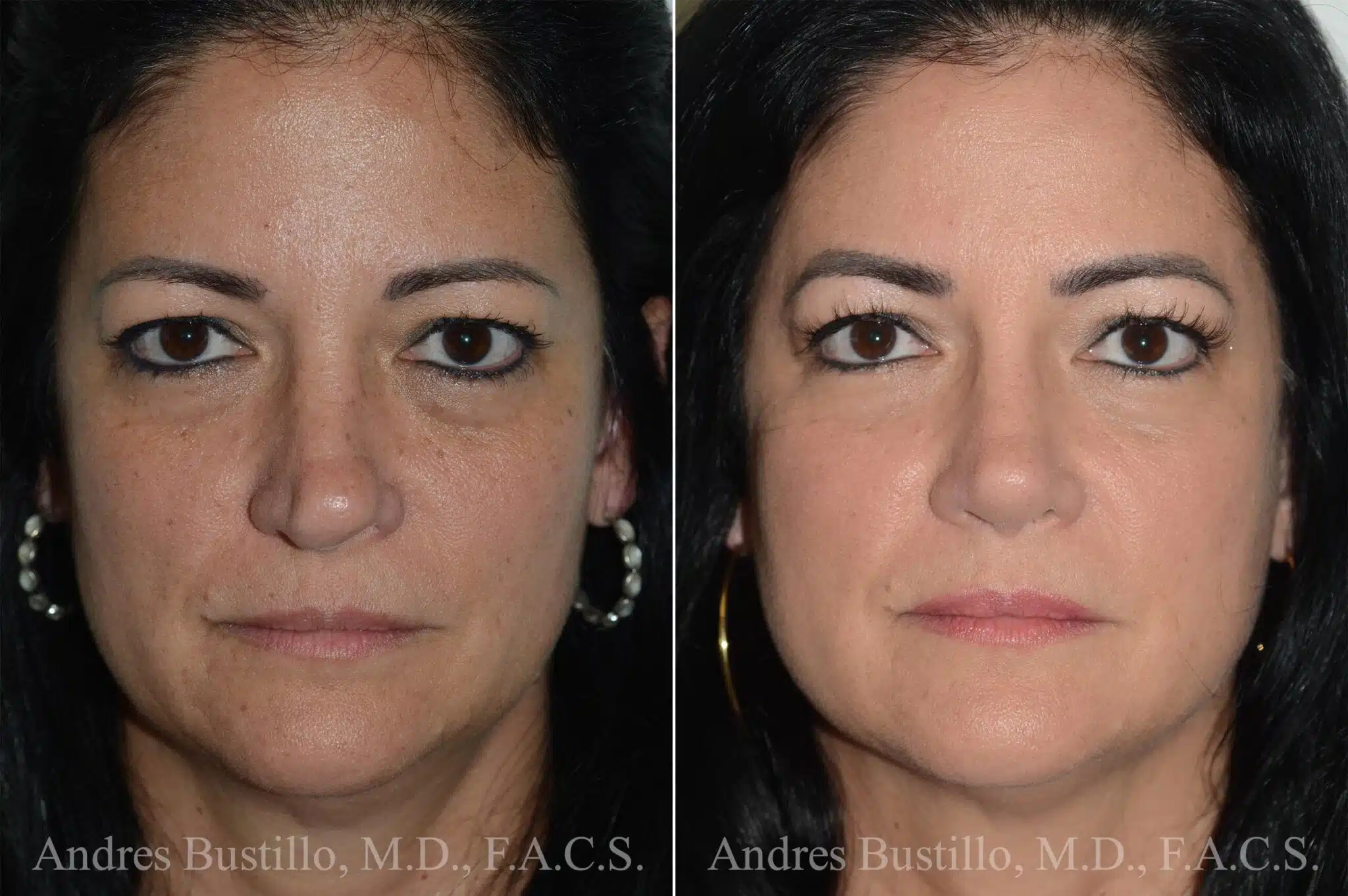 Nostril Reshaping to Restore your Confidence | Miami, FL