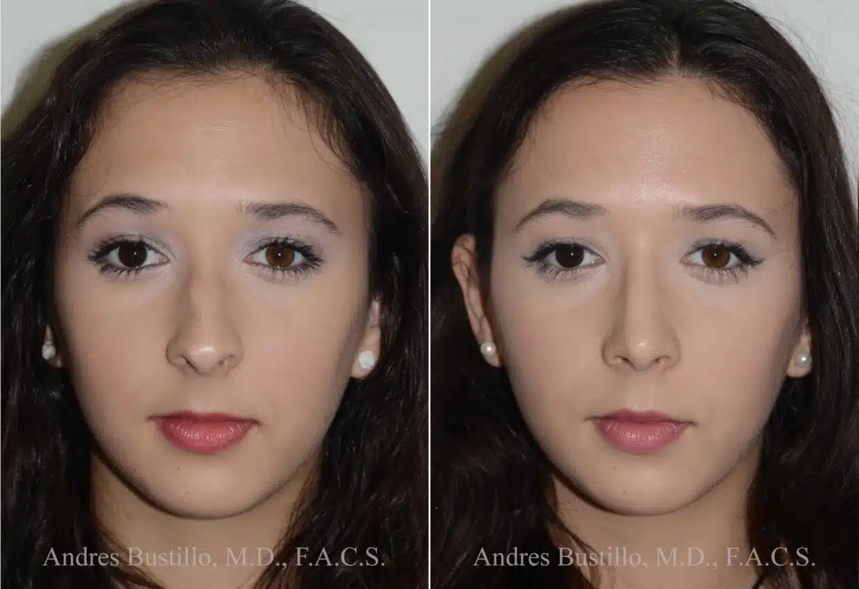 Healing Scars After Rhinoplasty: Expert Tips for Minimization