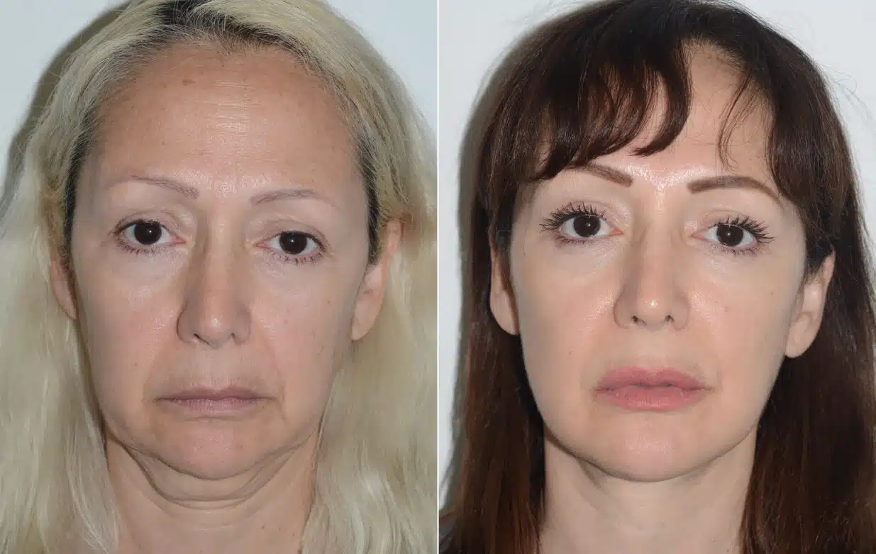 Deal with Facelift Scars: Discover Pro Tips & Tricks!