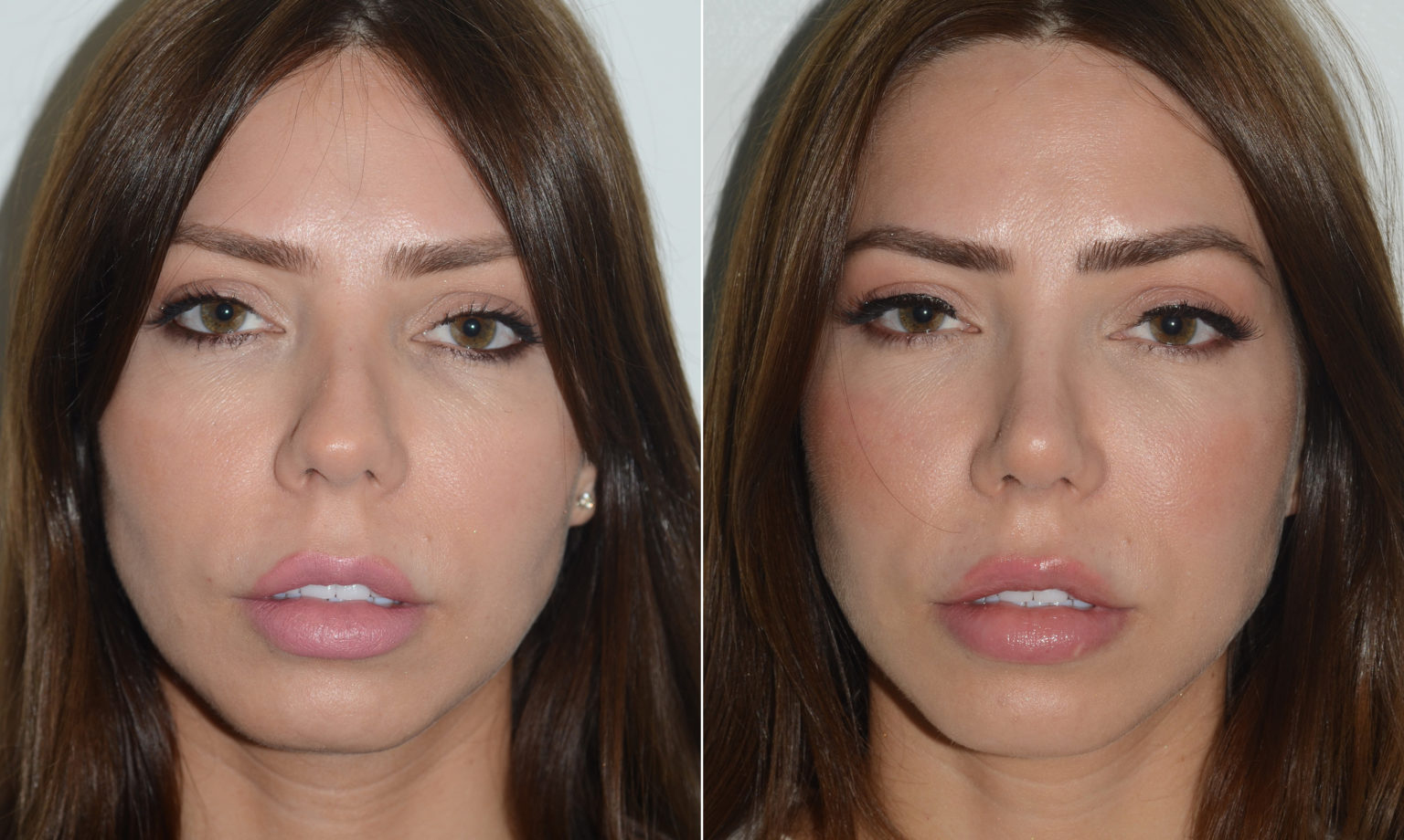 Building a Better Nose with Cartilage Grafts | Miami, FL
