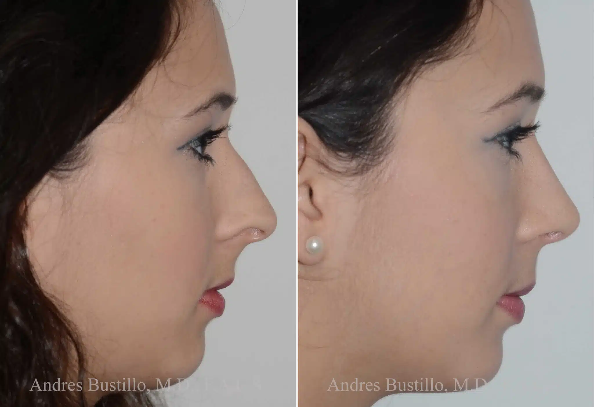 Healing Scars After Rhinoplasty: Expert Tips for Minimization