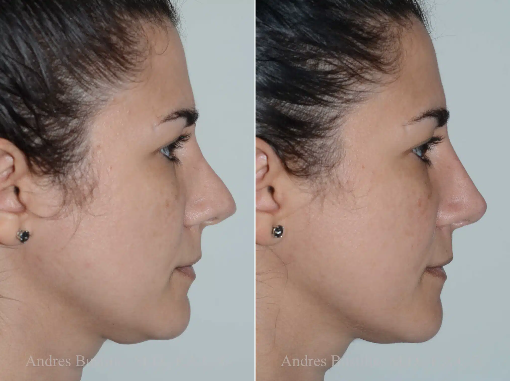 Nostril Reshaping to Restore your Confidence | Miami, FL