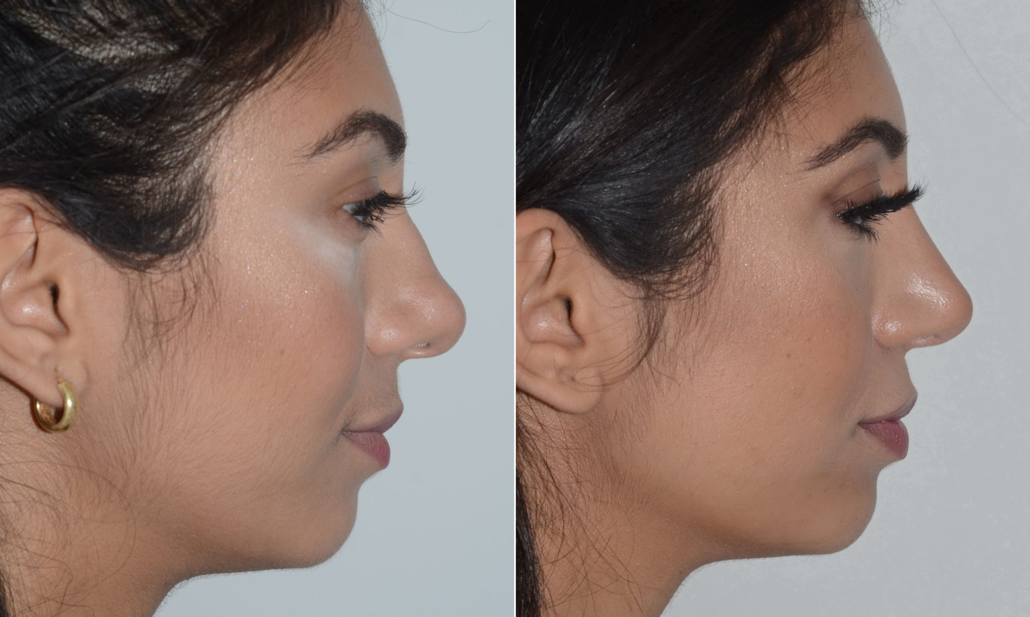 Rhinoplasty Can Fix a Crooked Nose | Miami, FL
