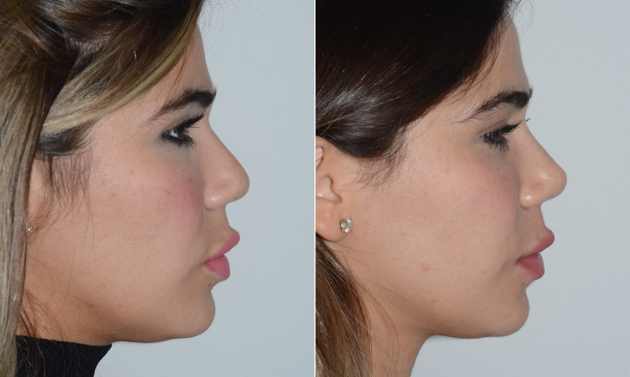 Correcting the 'Piggy Nose' Effect After Rhinoplasty | Miami, FL