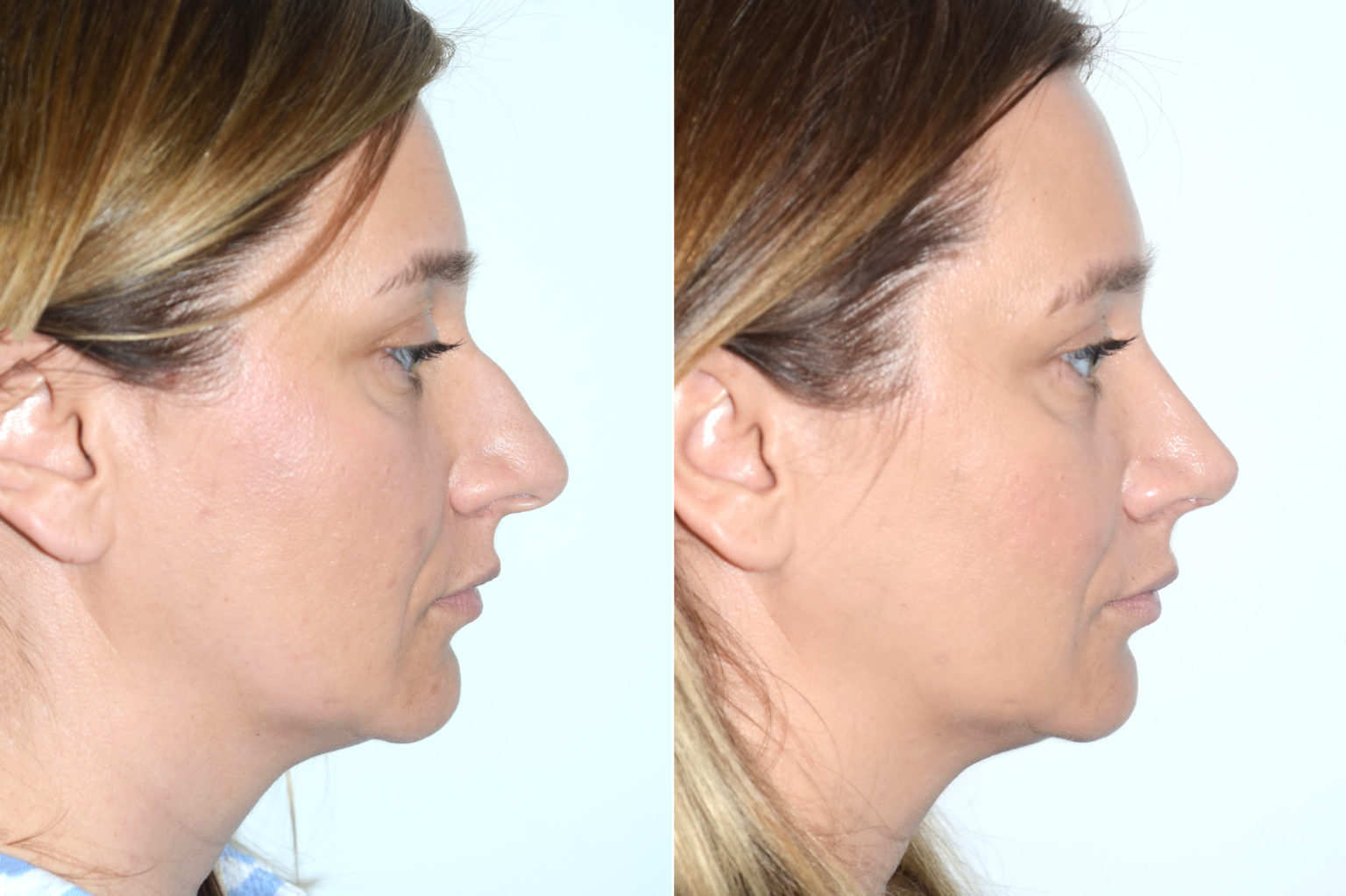 Hook Nose Rhinoplasty: Transforming Your Profile | Miami, FL