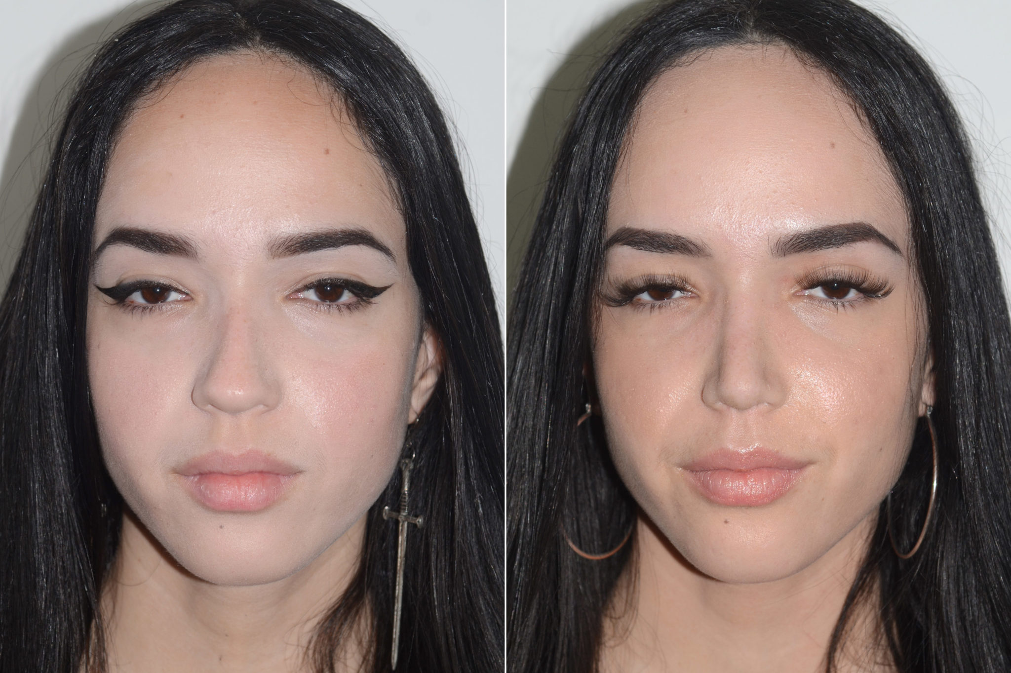 Hook Nose Rhinoplasty: Transforming Your Profile | Miami, FL
