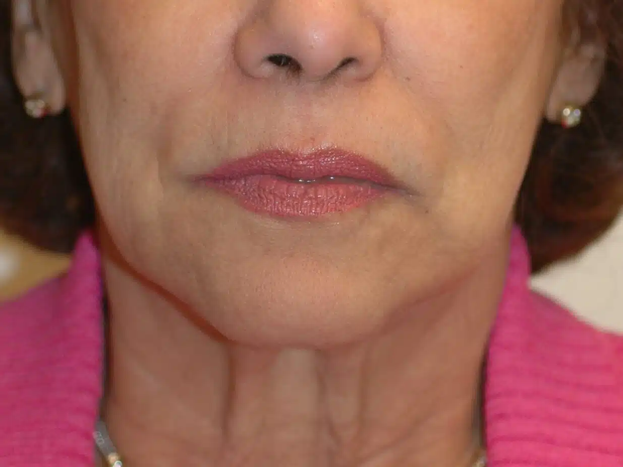 Neck Lift Miami - Rejuvenate Your Neck with Dr. Bustillo