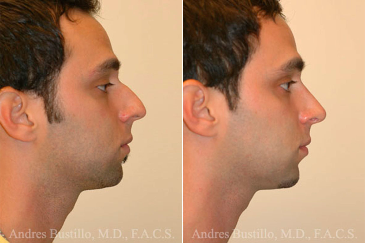 Hook Nose Rhinoplasty: Transforming Your Profile | Miami, FL