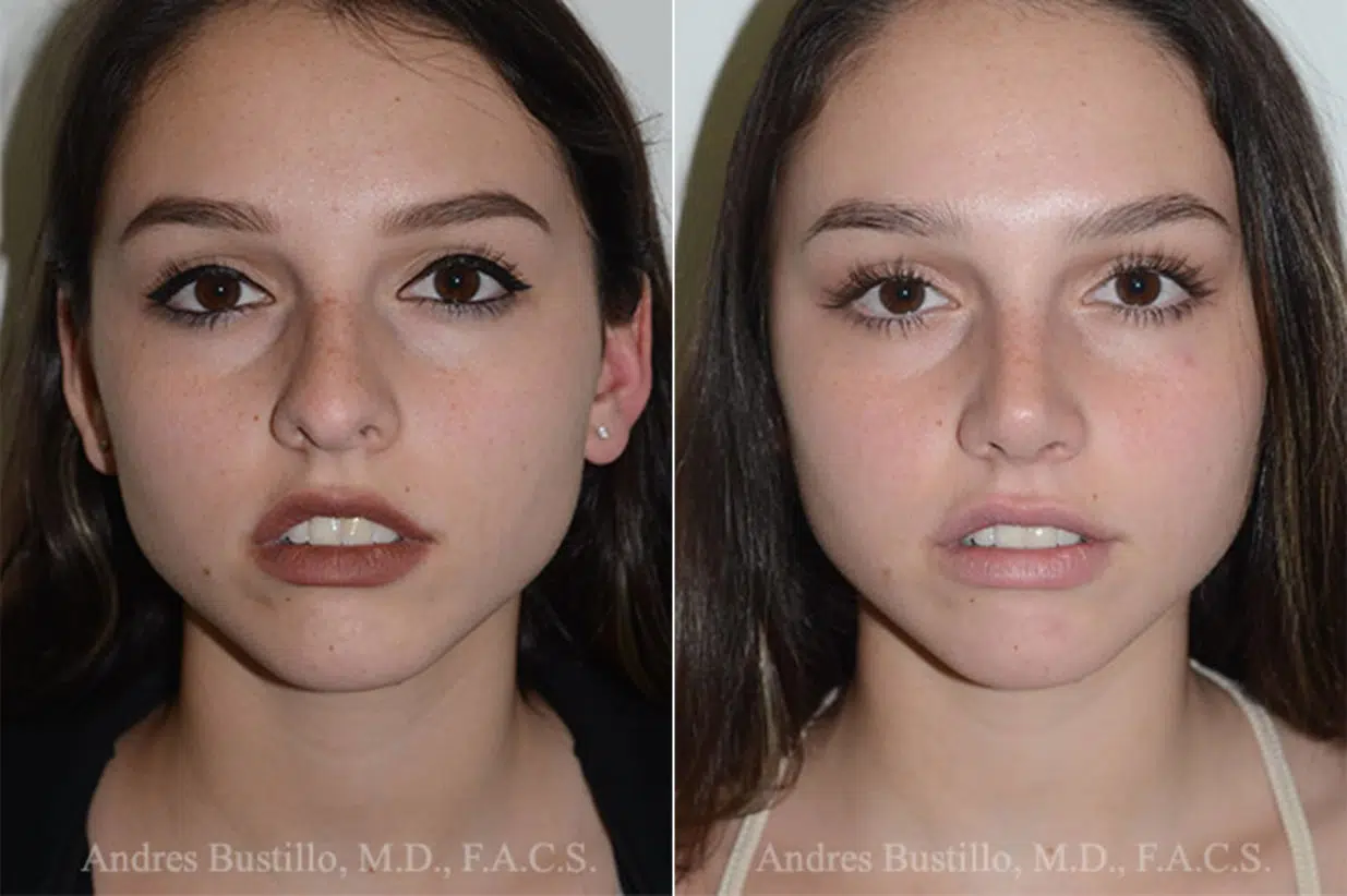 Rhinoplasty Miami, FL | Nose Surgery | Andres Bustillo, MD, FACS