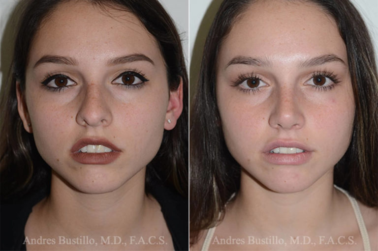 Minimize Scar Tissue After Rhinoplasty - Tips & Tricks | Miami