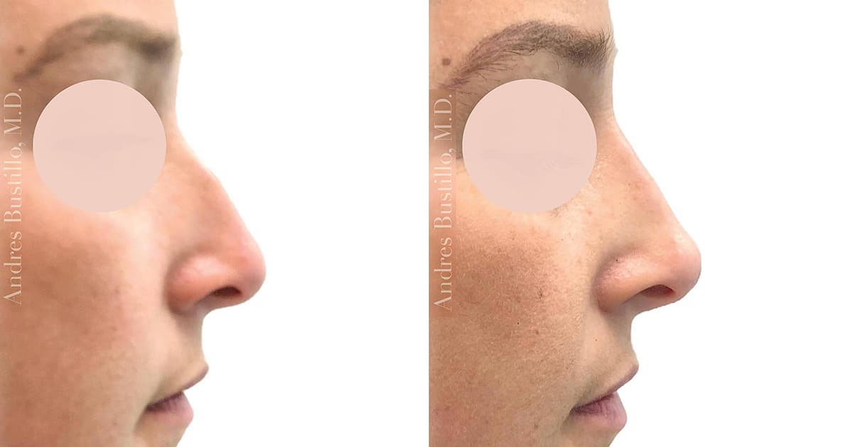 Liquid Rhinoplasty Miami - Non-Surgical Nose Job with Dr. Bustillo