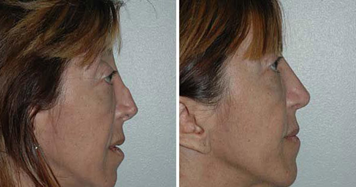 Revision Rhinoplasty Miami - Perfect Your Nose with Dr. Bustillo