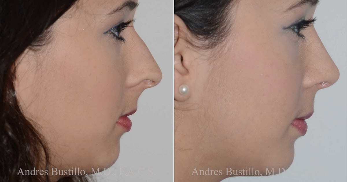 Rhinoplasty Miami, FL | Nose Surgery | Andres Bustillo, MD, FACS