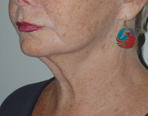 Neck Lift Miami - Rejuvenate Your Neck with Dr. Bustillo