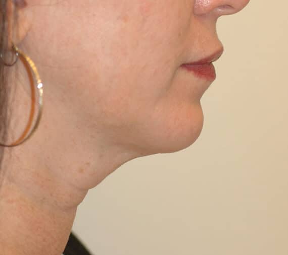Neck Lift Miami - Rejuvenate Your Neck with Dr. Bustillo
