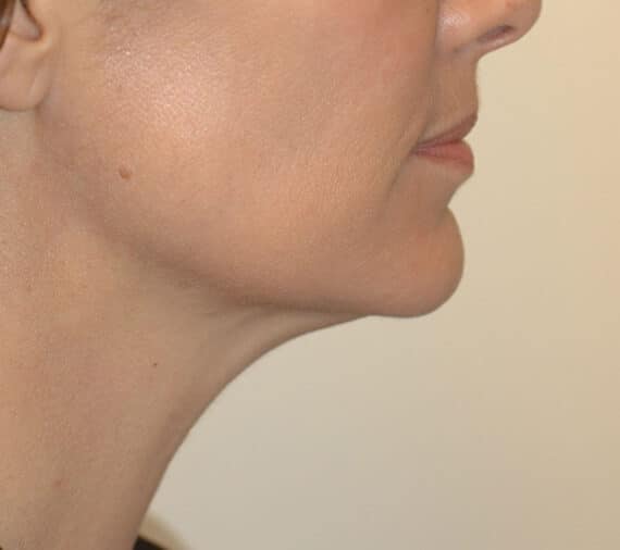 Neck Lift Miami - Rejuvenate Your Neck with Dr. Bustillo