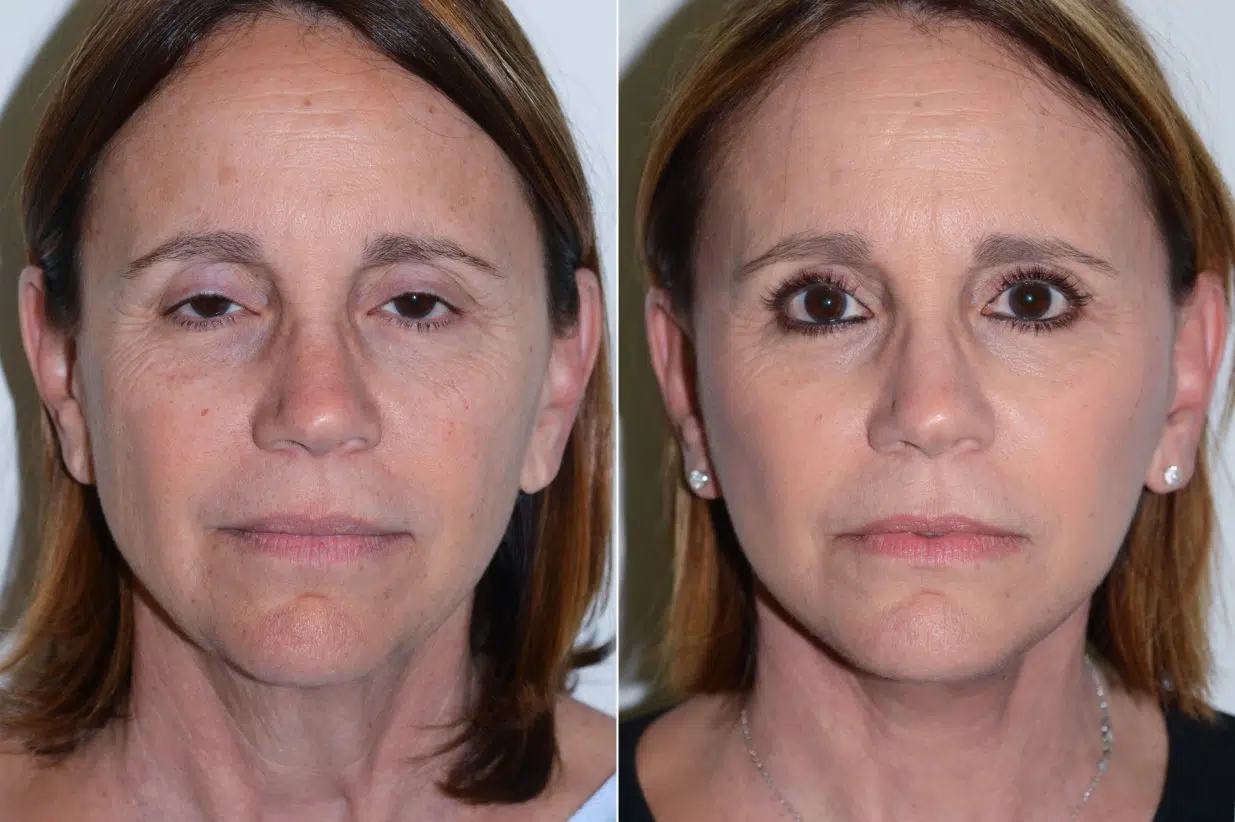 Deep Plane Facelift | Miami