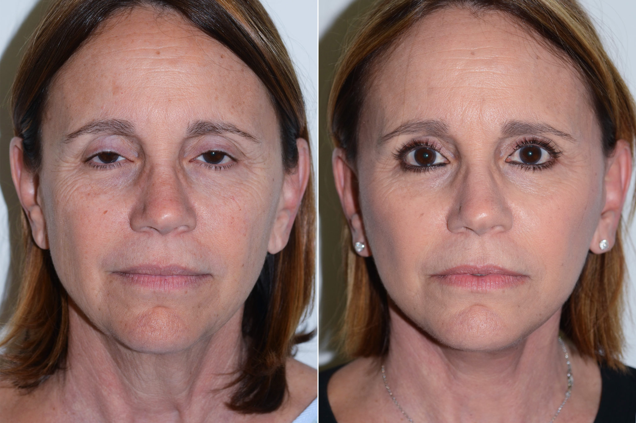 Deep Plane Facelift | Miami