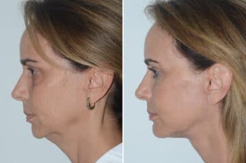 Fix Your Witches Chin | Non-Surgical and Surgical Solutions