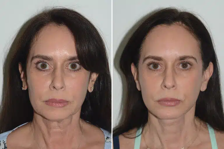 Fix Your Witches Chin | Non-Surgical and Surgical Solutions