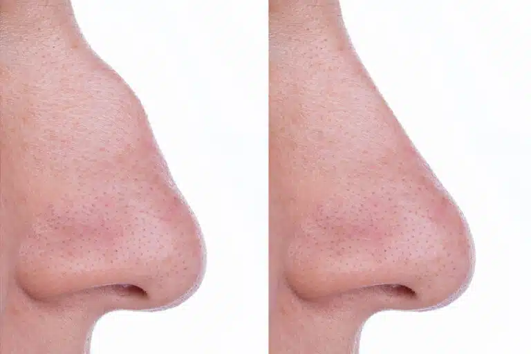 Hook Nose Rhinoplasty: Transforming Your Profile | Miami, FL