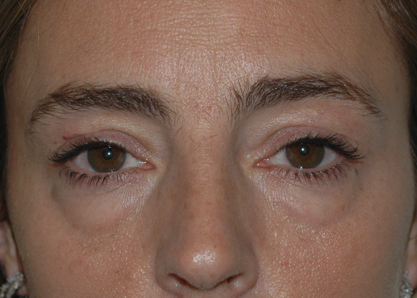 Blepharoplasty | Miami, FL