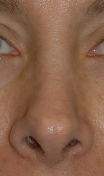 Revision Rhinoplasty | Miami, FL