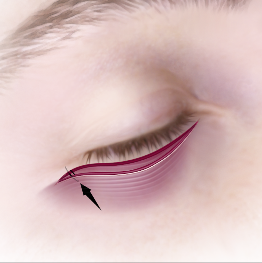 Blepharoplasty | Miami, FL | Eyelid Surgery | Dr. Bustillo